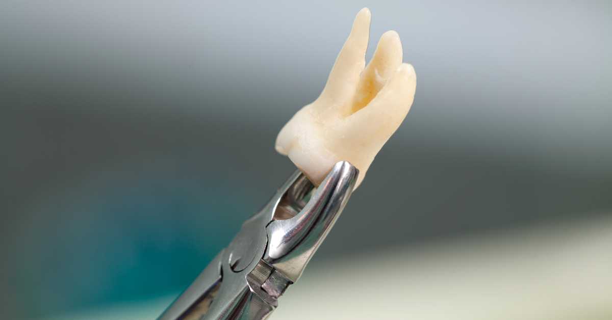 Talking After Wisdom Teeth Removal - Timeline, Dos & Don'ts