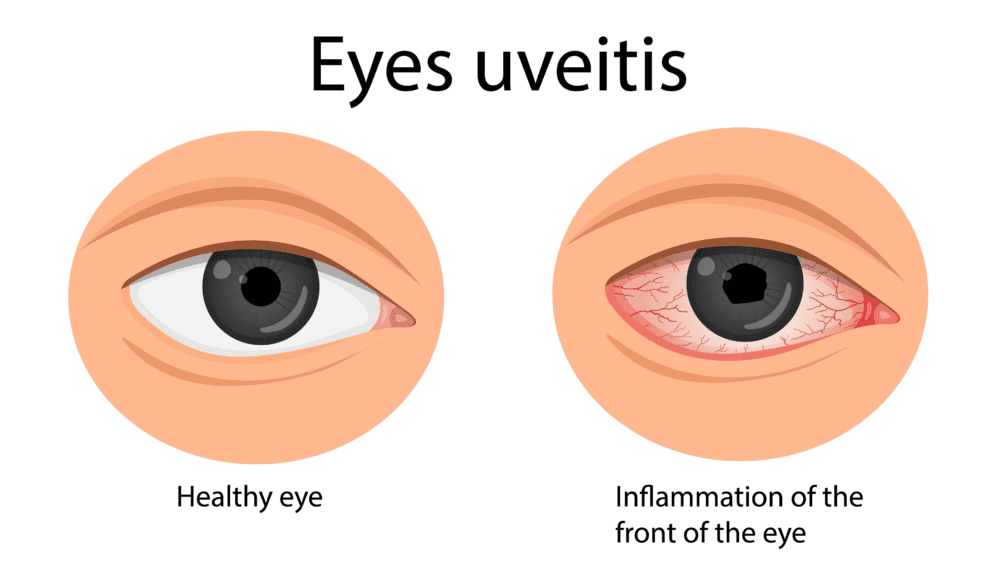 Will Uveitis Go Away On Its Own? | Eye Health Insights