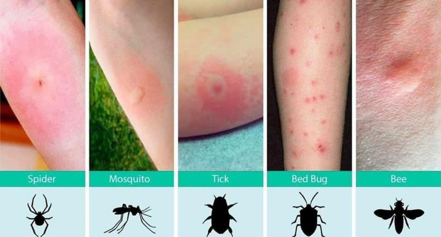 Bug Bites That Are Hard And Swollen | Understanding Symptoms