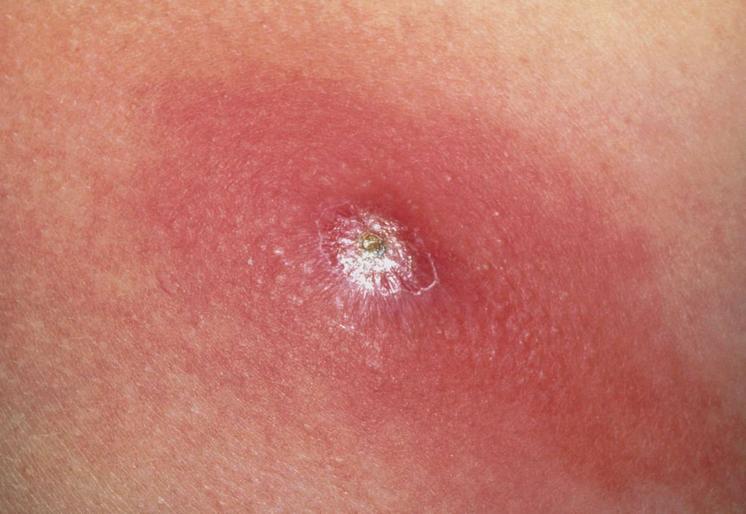 What To Do When a Boil Pops? | Essential Care Tips