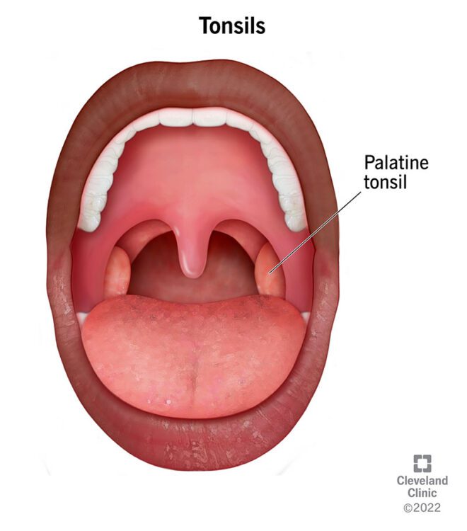 Why Have My Tonsils Been Swollen For Months? | Health Insights