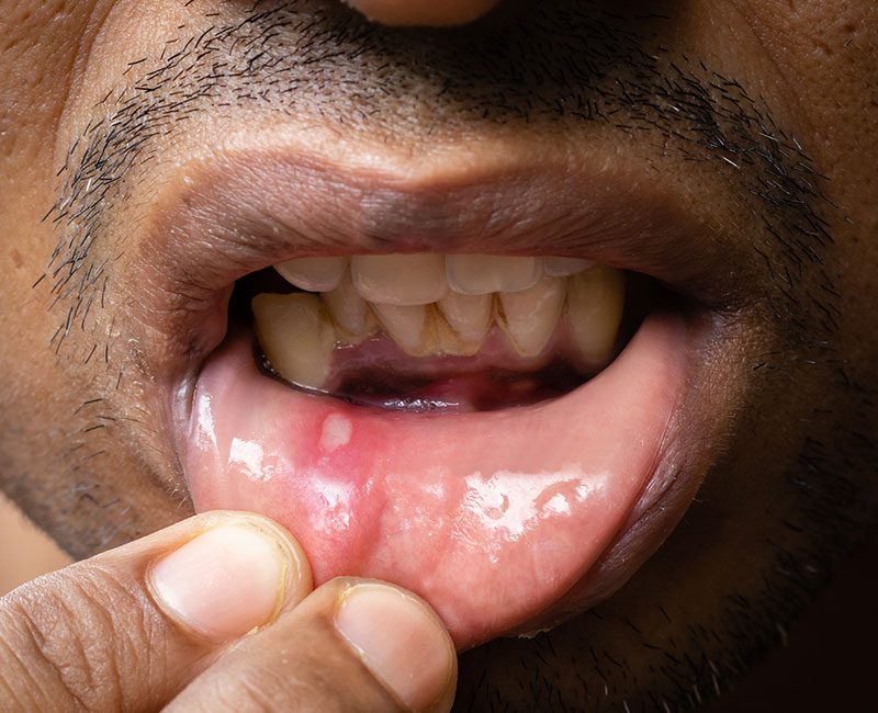 What Is Ulcer In Mouth? | Painful Insights