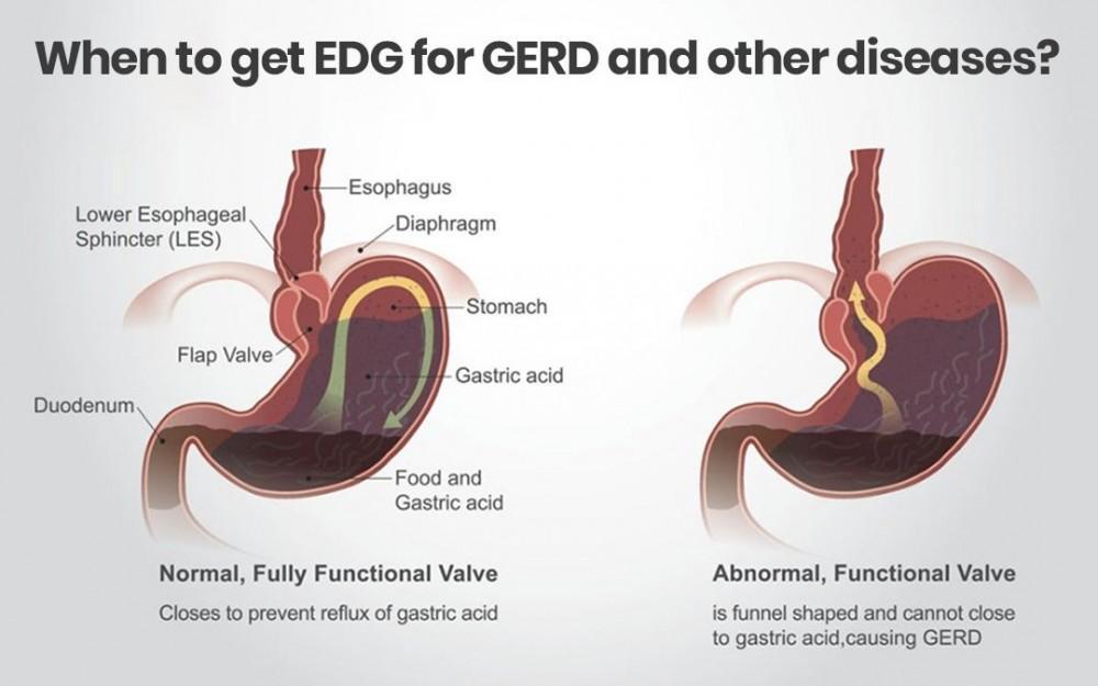 Does Gerd Cause Fast Heart Rate? | Heart Health Insights