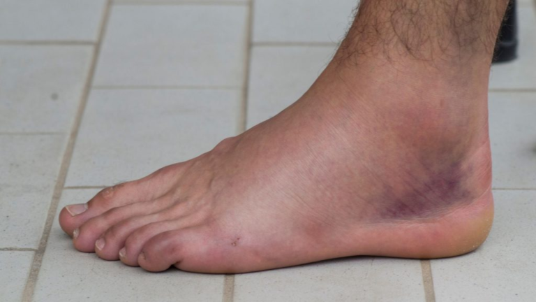 What Is a Sprained Ankle? | Symptoms, Causes, Treatments