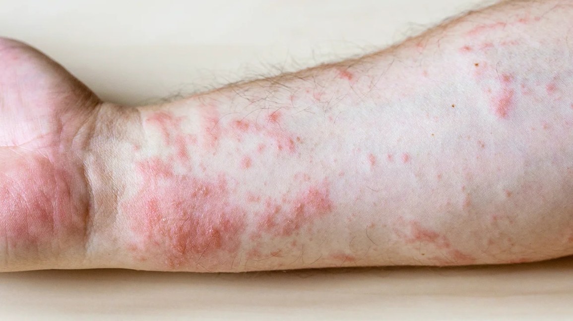 Is Rash Sign Of Cancer? | Uncover the Truth