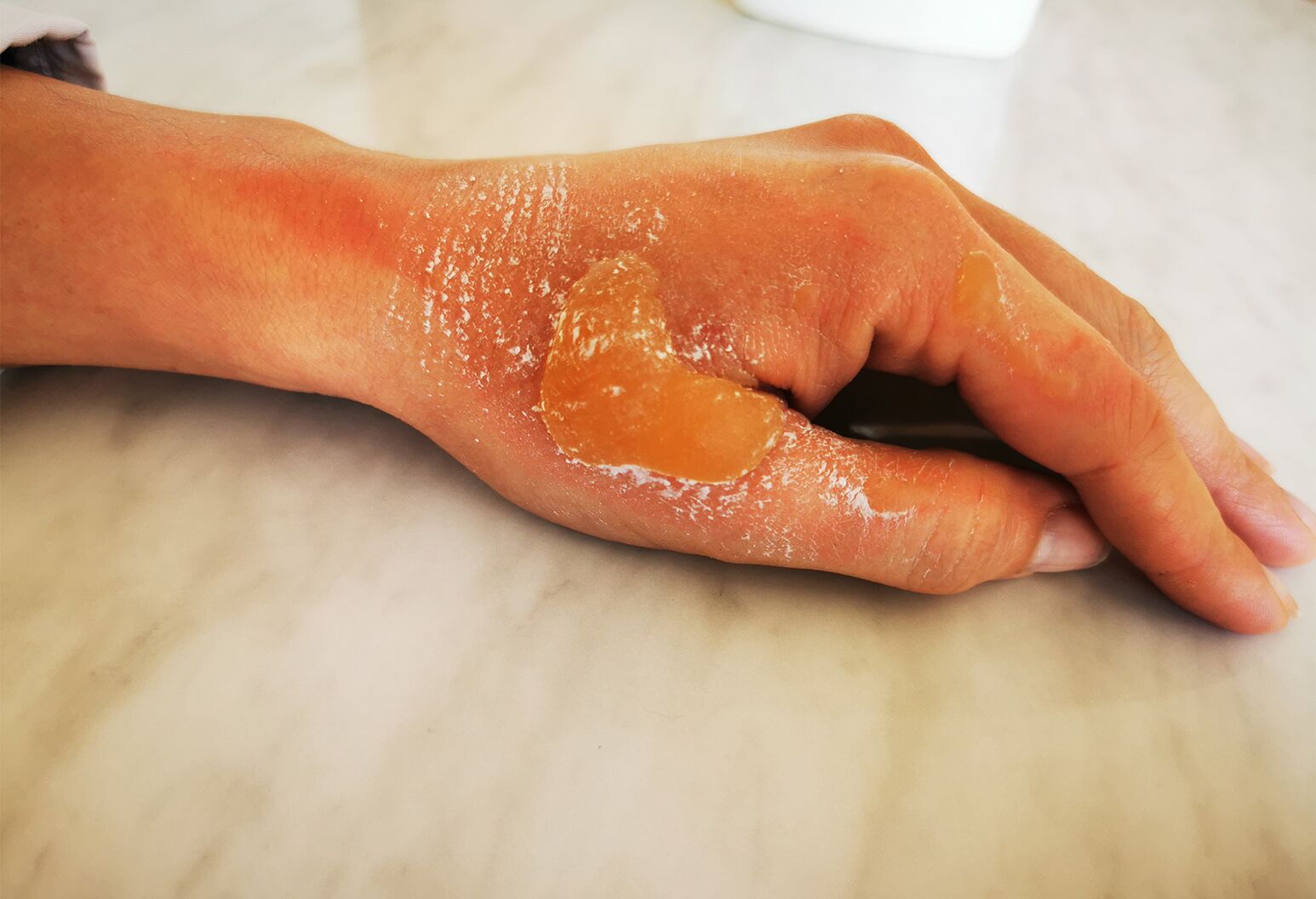 What To Do With A Steam Burn? | Essential Relief Tips