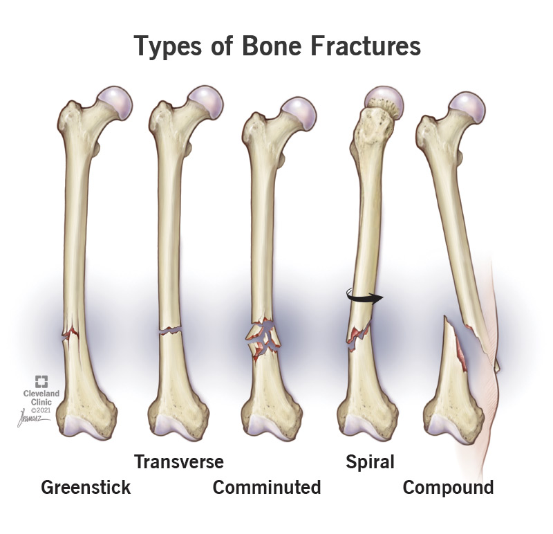 In Which Type Of Fracture Is The Bone Shattered? | Bone Break Basics