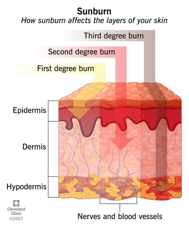 Will Sunburns Turn Into Tans? | Skin Secrets Unveiled