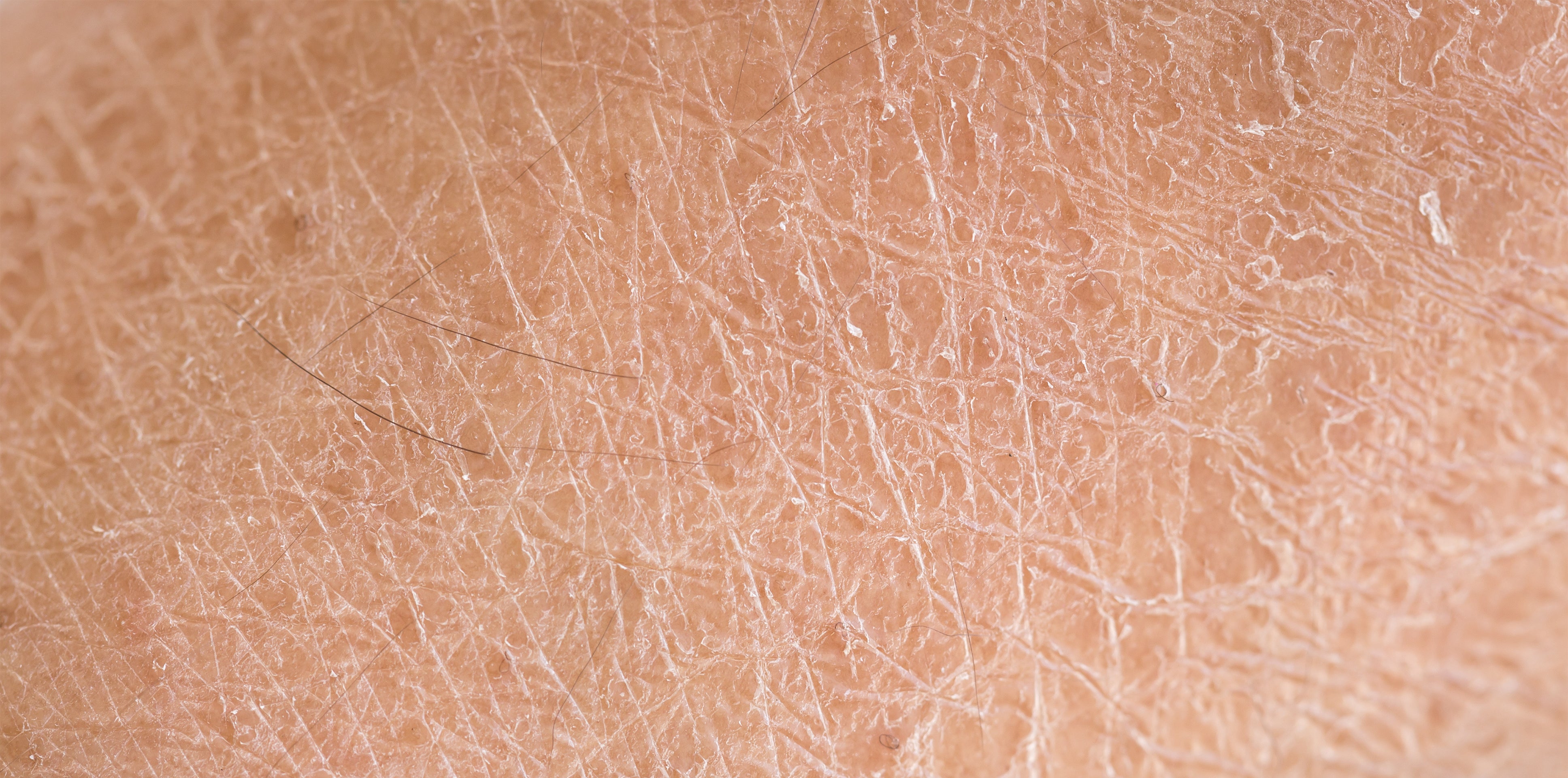 What To Do To Dry Skin? | Hydration Hacks