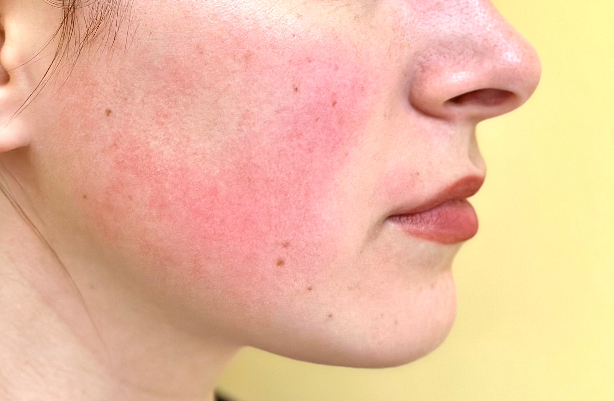 How To Get Rid Of Rosacea Redness On Face? | Radiant Solutions