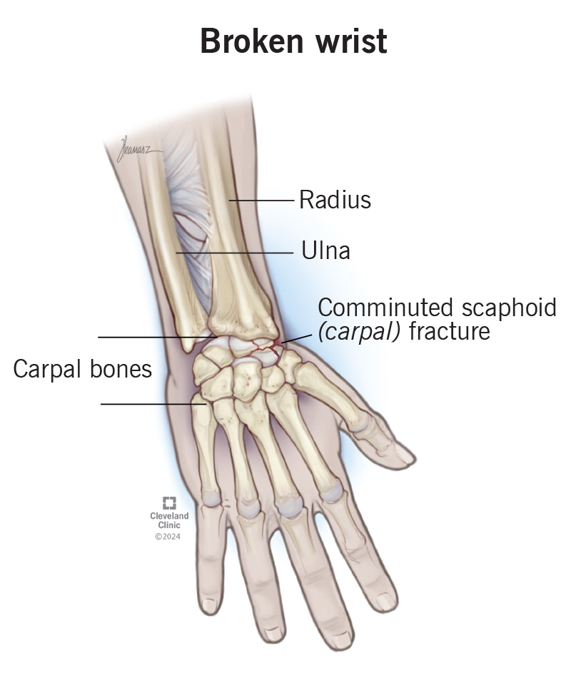 How Painful Is A Broken Wrist? | Gripping Insights