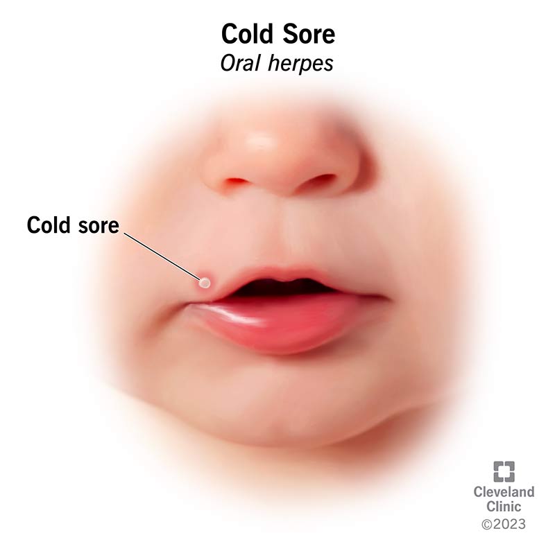 How To Make A Cold Sore Scab Heal Faster Quick Recovery Tips