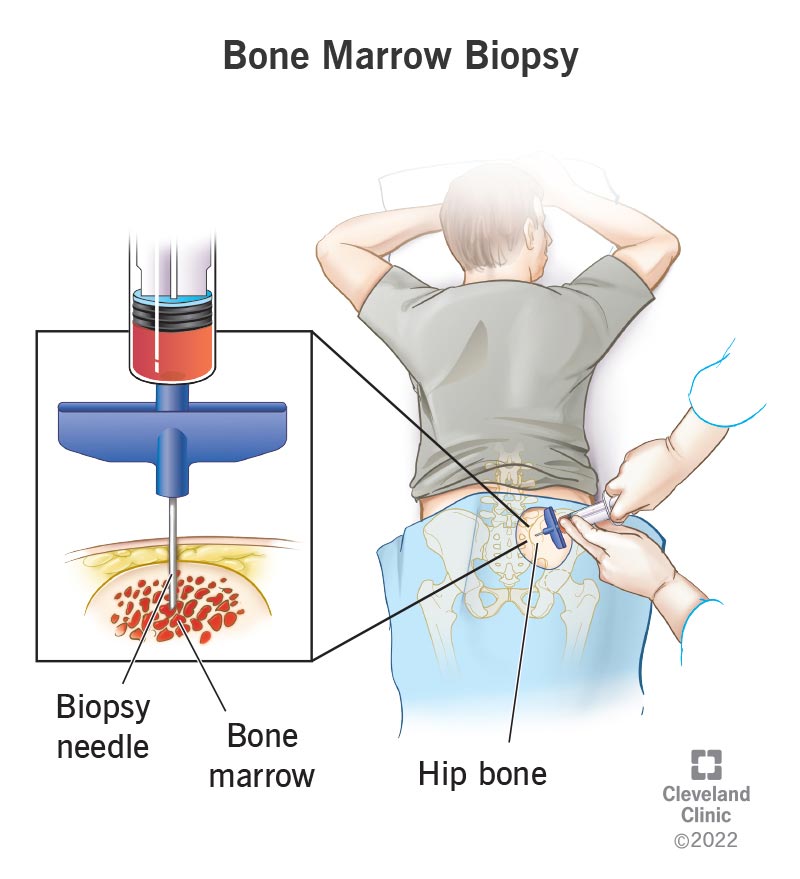 What Is The Bone Marrow Test? | Essential Insights