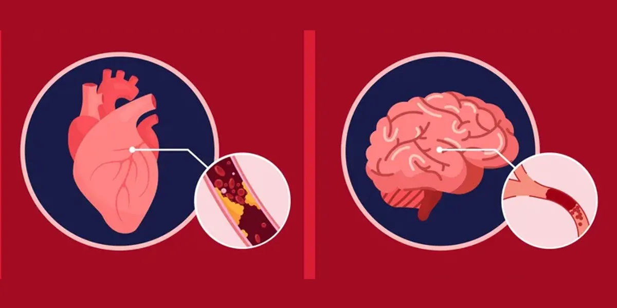 How Does Strokes Occur? | Understanding the Triggers
