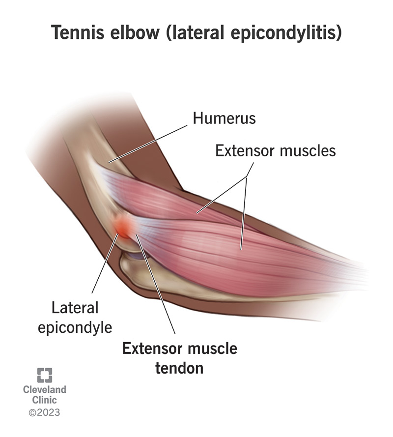 What is tennis elbow feel like? | Painful Insights