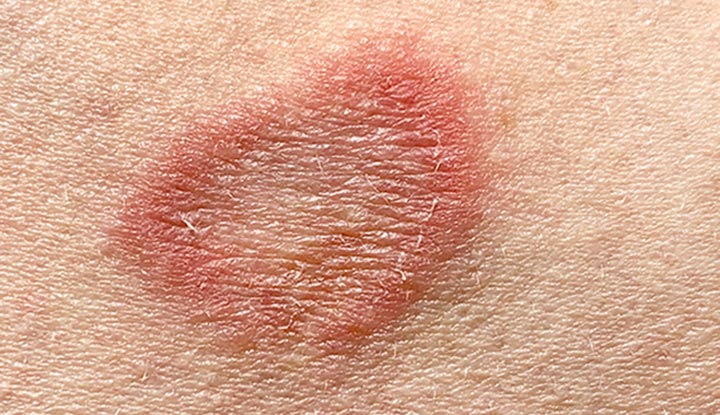 What Is A Ringworm Rash? | Skin Care Uncovered
